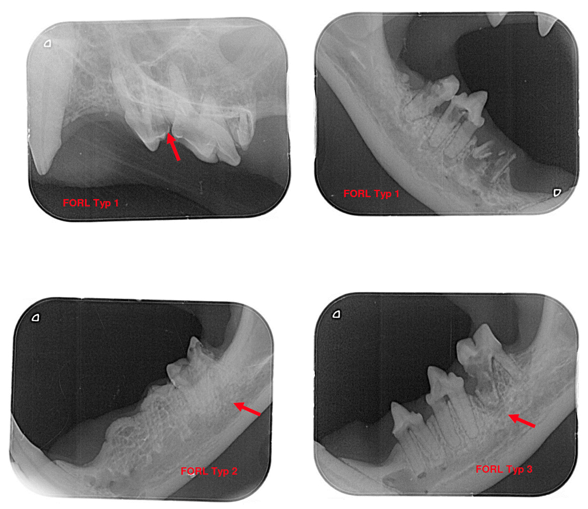 FORL (TR=Tooth Resorption/RL=Resorptive Läsion ...